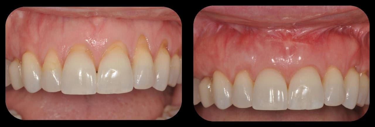 Soft Tissue Grafting Seattle WA - Gum Grafting Seattle WA